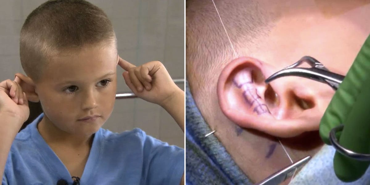 6 Year Old Gets Plastic Surgery After Being Bullied For Having Elf Ears