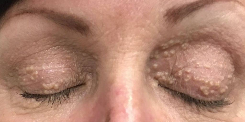 Watch Dr Pimple Popper Remove So Many Milia From This Patients