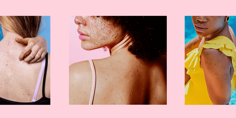 How To Get Rid Of Body Acne Dermatologist Tips On Treating Boob Acne