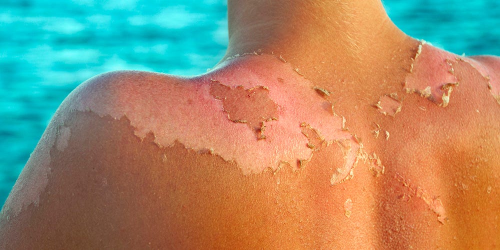 11 Sunburn Remedies That Work How To Get Rid Of Sunburn Fast