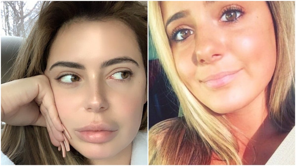 Brielle Biermann Dissolves Lip Fillers Before And After