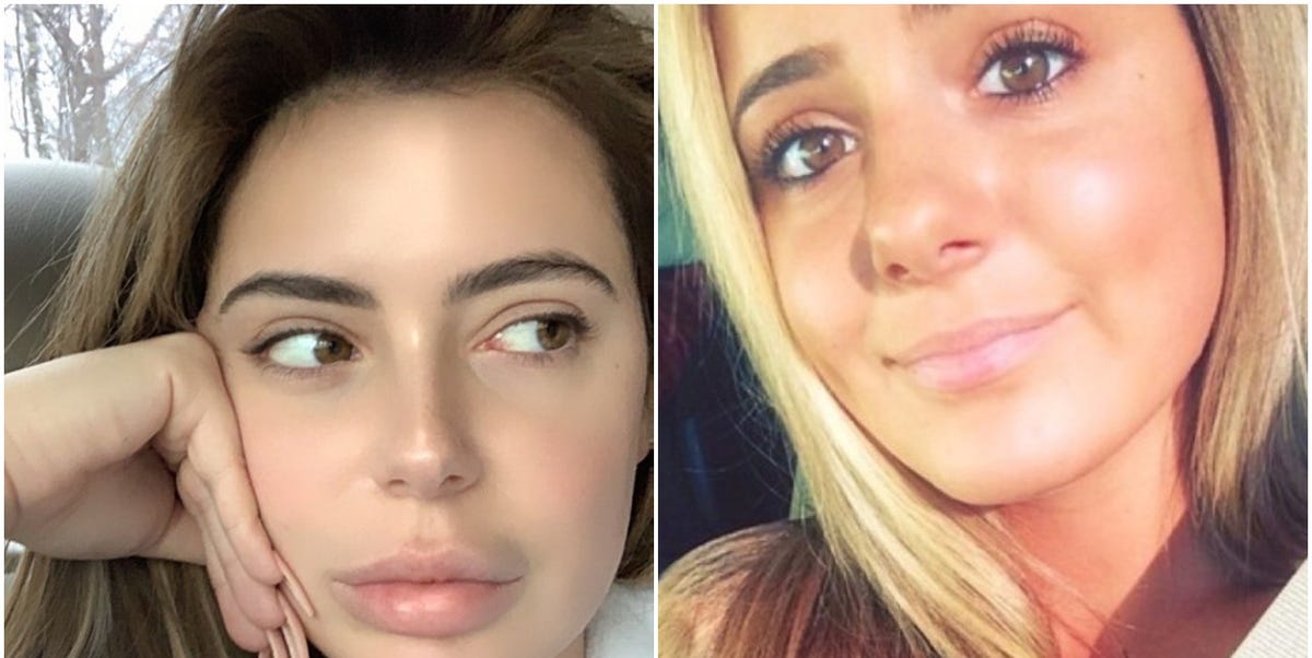 Brielle Biermann Dissolves Lip Fillers Before And After