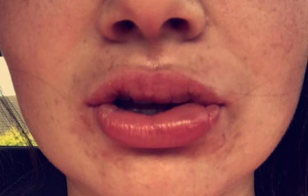 Are Swollen Lips Serious