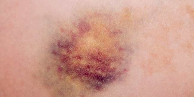 How To Heal Your Bruises A Whole Lot Faster