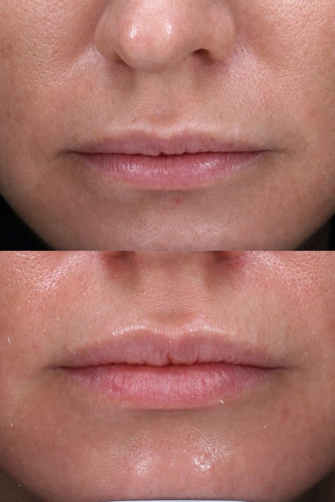 Heres What You Need To Know About The Lip Flip