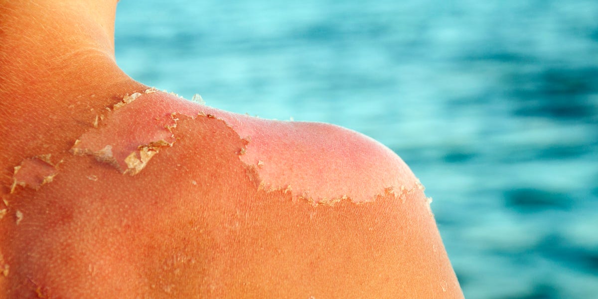 Sunburn Peeling Causes Plus Skin Remedies To Heal Faster