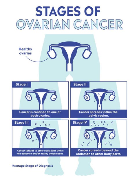 What Is Ovarian Cancer Symptoms Causes Treatment Types
