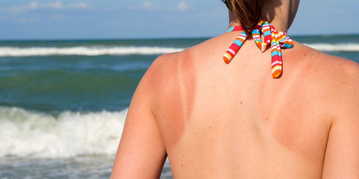 Dermatologist Claims Cold Milk Is Best Cure For Sunburn How To Sooth