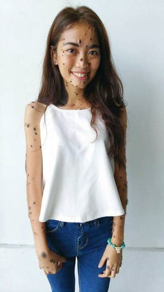 Miss Universe Contestant Embraces Her Head To Toe Moles Evita Delmundo