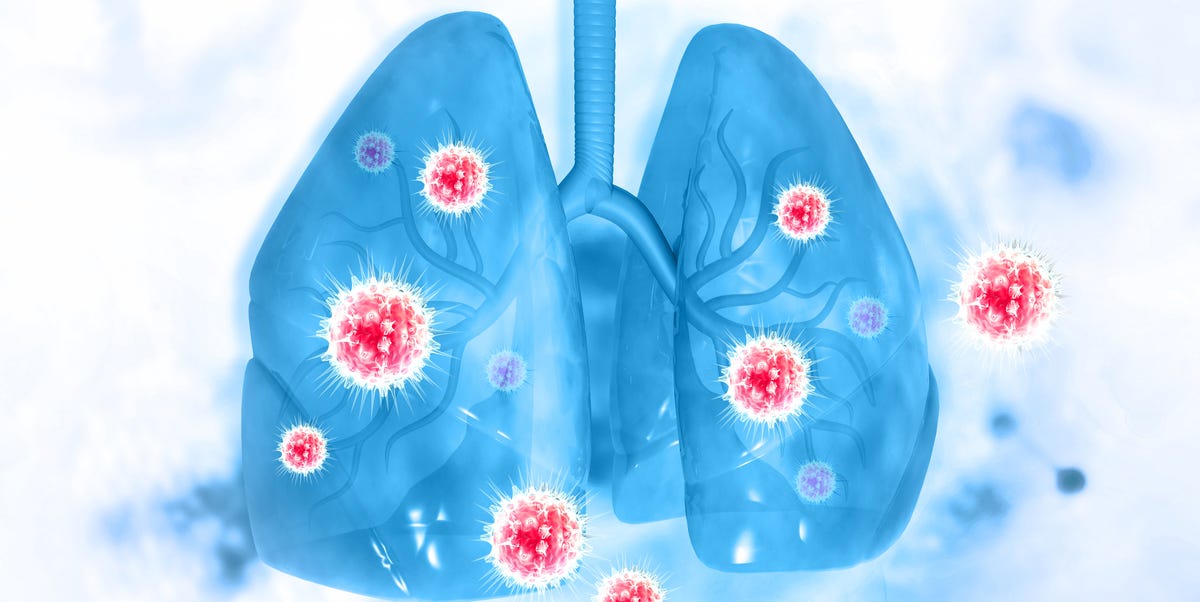 What Is Double Pneumonia And How Serious Is It Doctors Explain