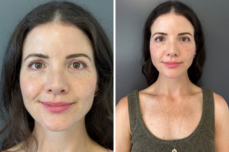 I Tried Prp Injections For Dark Circles Prp For Under Eyes Before And