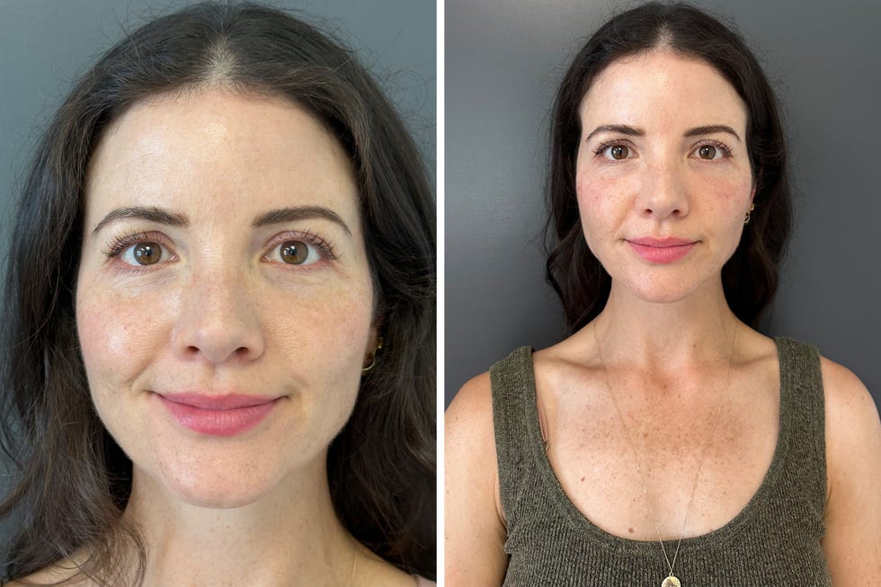 I Tried Prp Injections For Dark Circles Prp For Under Eyes Before And