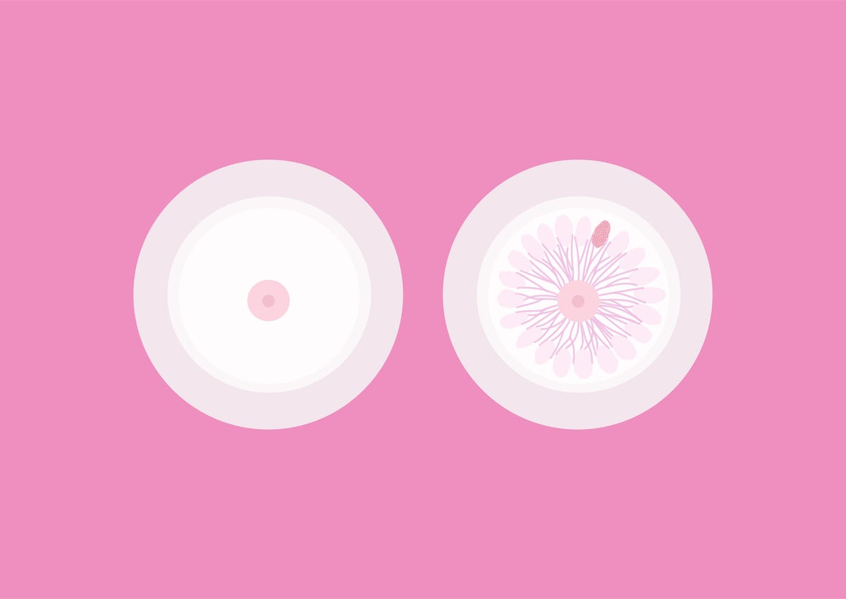Understanding Breast Cancer Stages And Their Importance In Prognosis