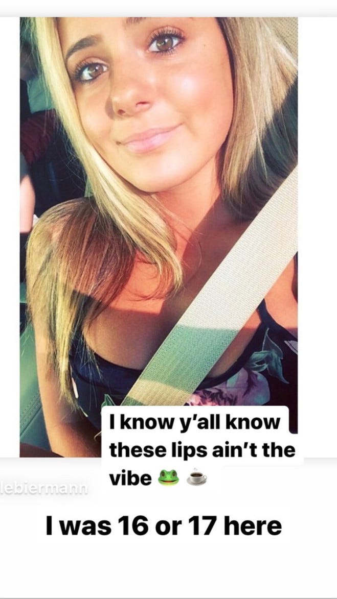 Brielle Biermann Dissolves Lip Fillers Before And After