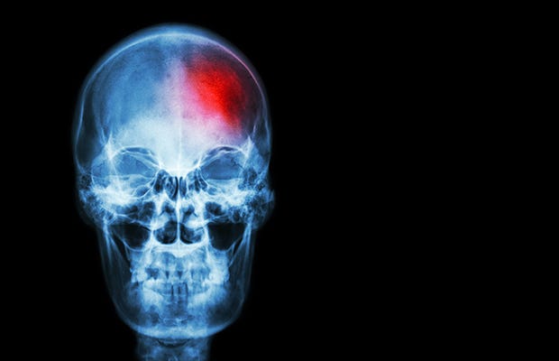 Shingles Increases Stroke Risk Prevention