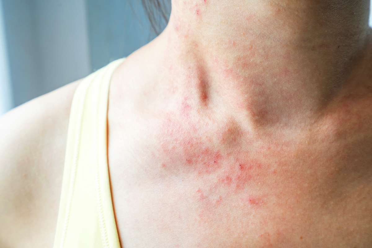 Itchy Why Your Eczema is Flaring Up