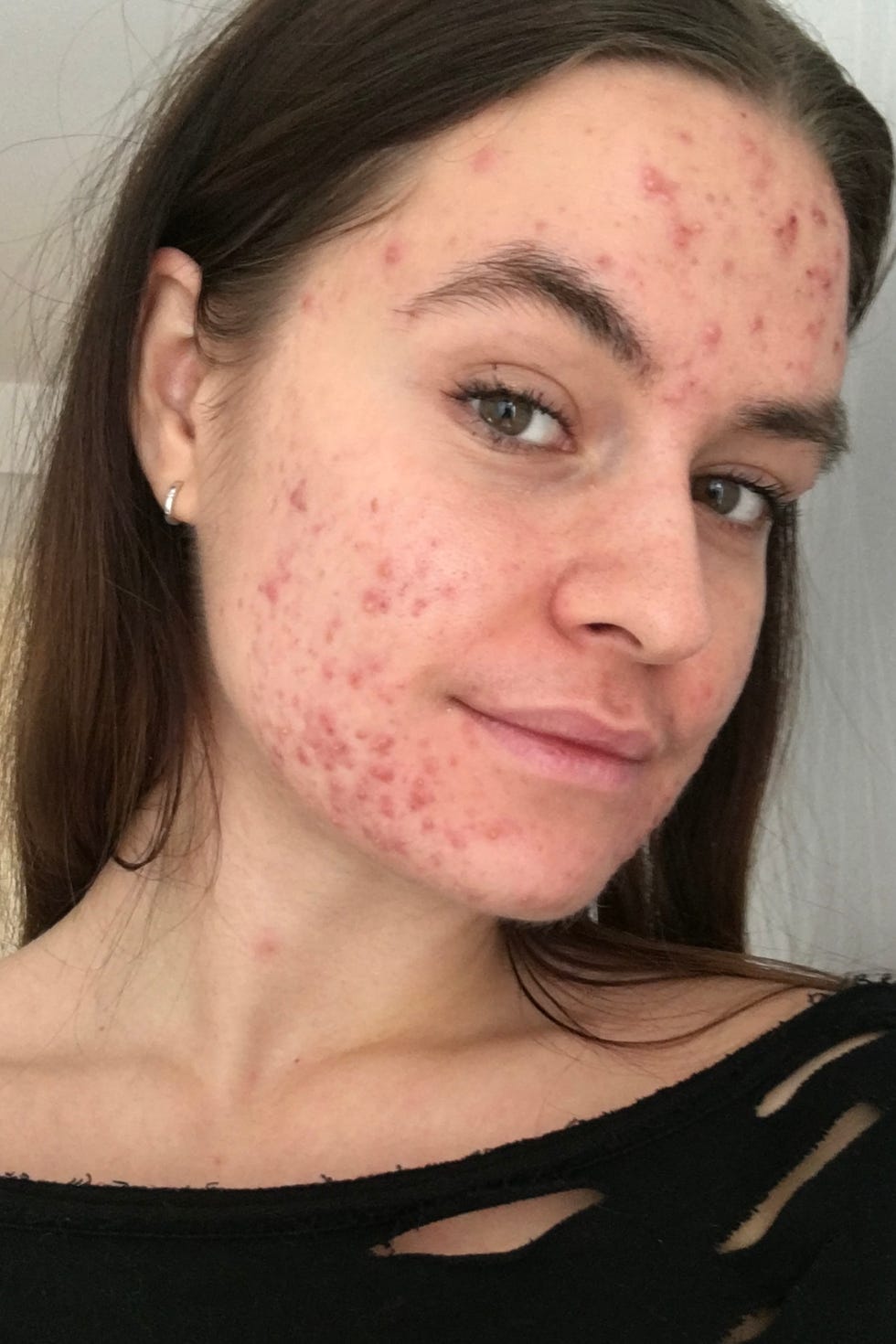 Accutane Before And After 9 Women On Their Isotretinoin Side Effects