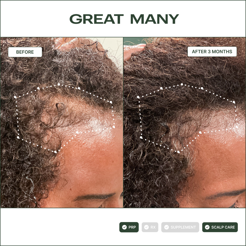 A Solution to Perimenopausal Hair Loss