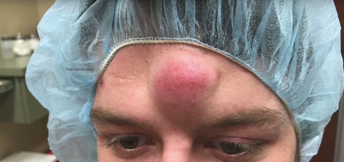 Watch Dr Pimple Popper Go To Town On This Fully Ripe 6 Year Old Unicorn Cyst