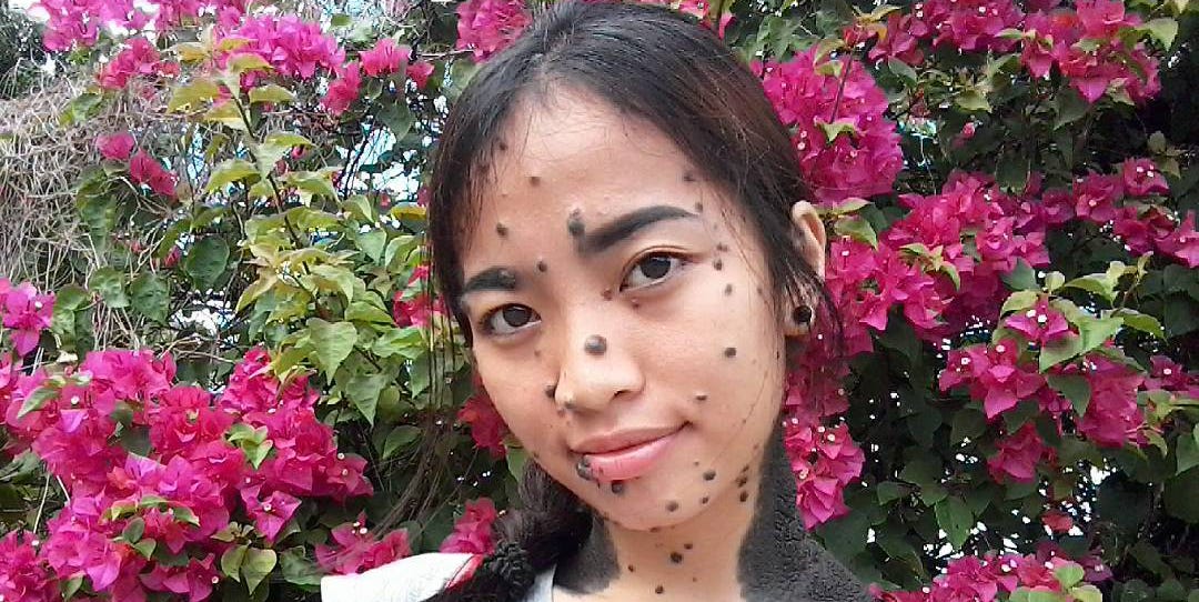 Miss Universe Contestant Embraces Her Head To Toe Moles Evita Delmundo