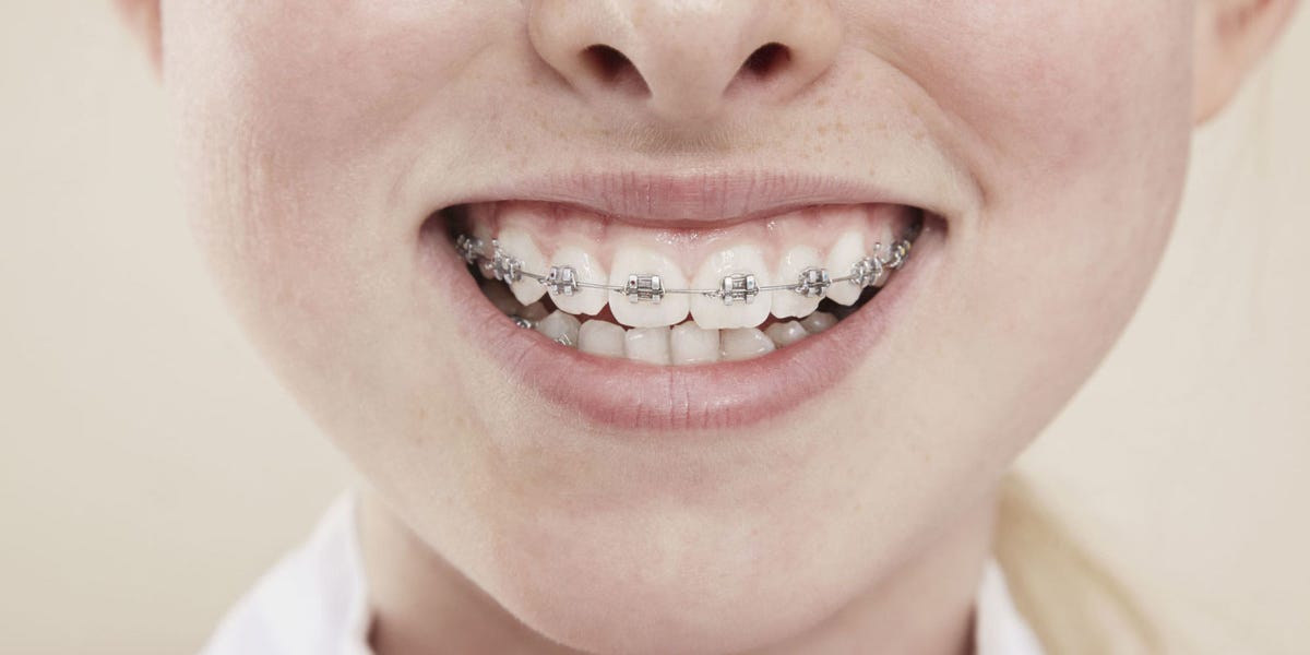 Why The Diy Braces Trend Is Seriously So Dangerous